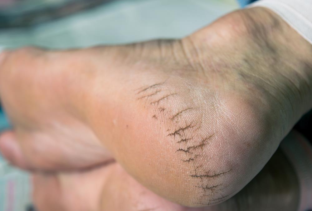 How Does Chemical Neurolysis Treat Neuromas? | The Metroplex Foot and ...